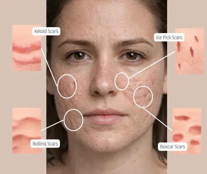 Types of Acne Scars and the Most Effective Treatments for Each - Parpar